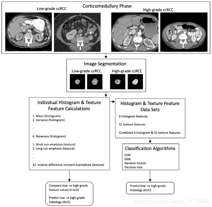 SRM benign & malignant, RCC classification, (clear cell RCC) grading ...