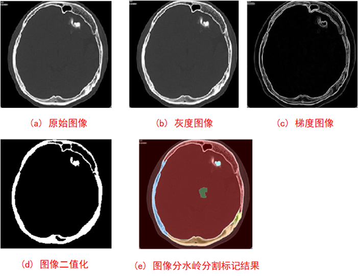 基于分水岭分割算法的CT图像智能诊断研究-含Matlab代码_ct影像分类matlab-CSDN博客