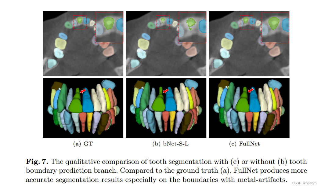 Hierarchical Morphology-Guided Tooth Instance Segmentation from CBCT Images-CSDN博客