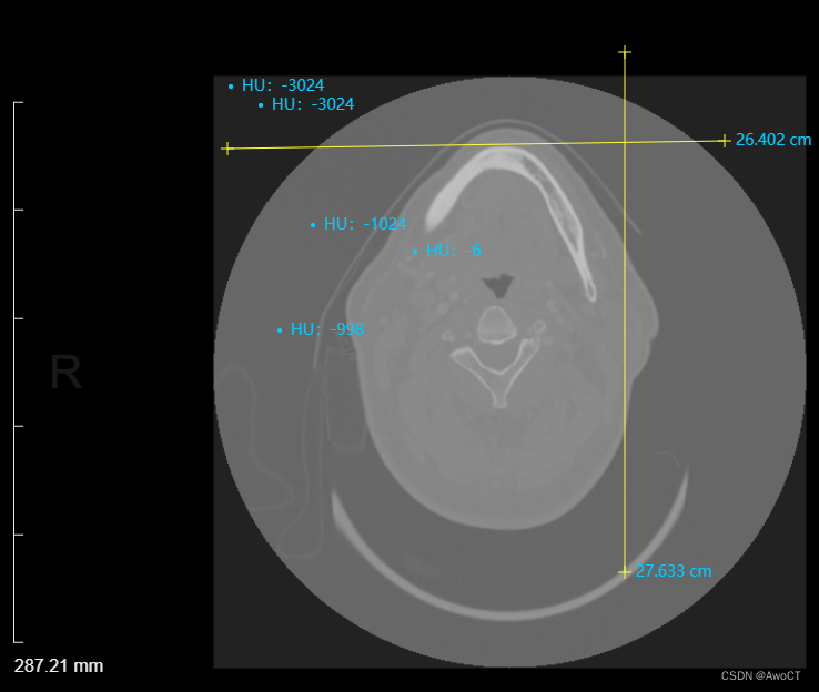 vtk.js加载dicom，获取世界点的坐标、两点之间的距离_vtk.js dicom-CSDN博客