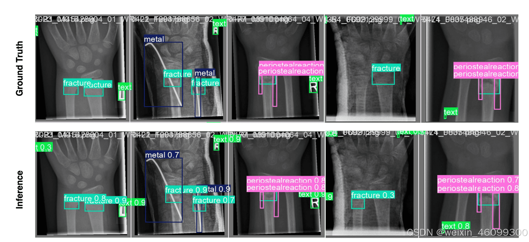 Pediatric Wrist Fracture Detection in X-rays via YOLOv10 Algorithm and Dual Label Assignment ...