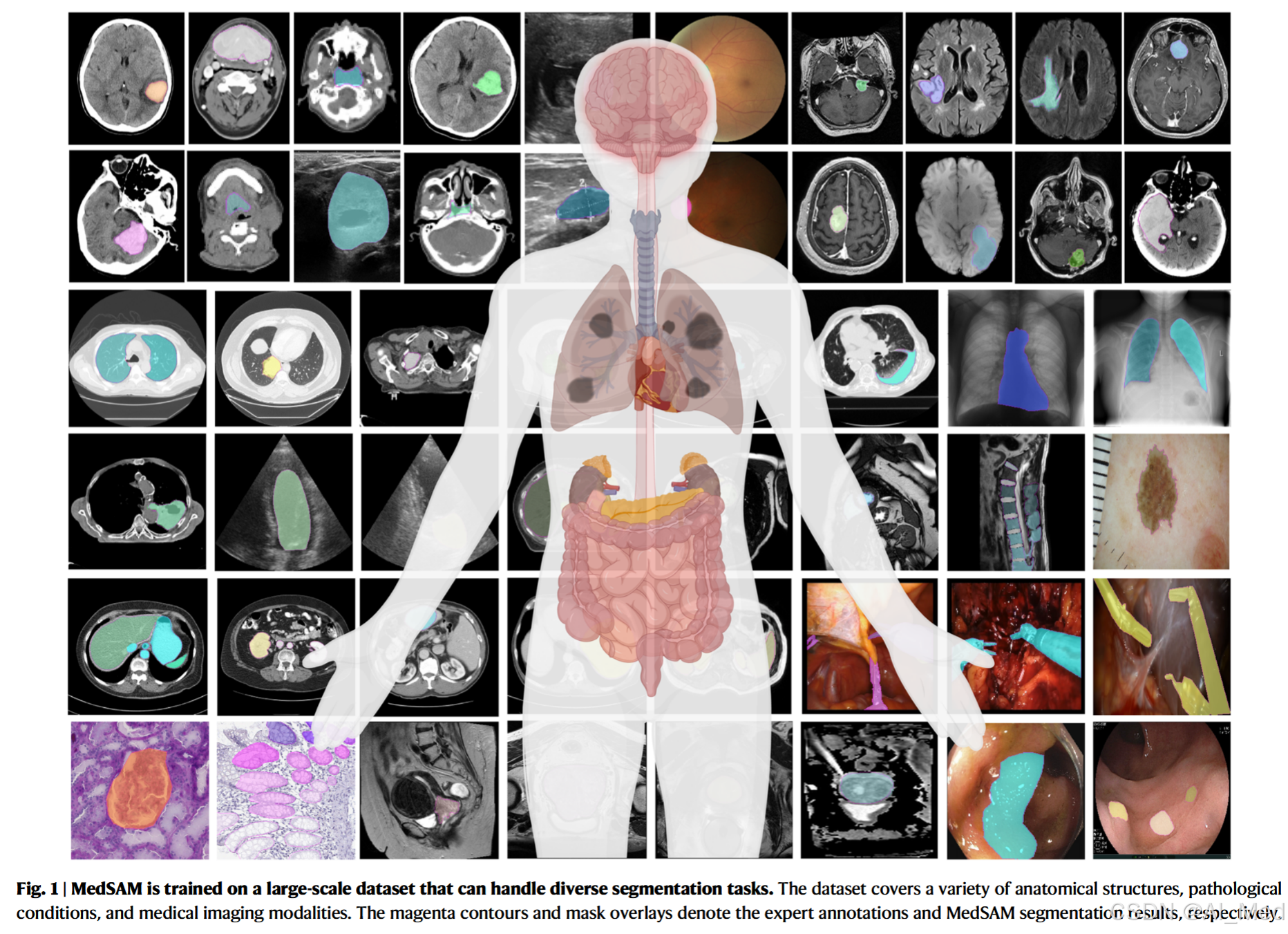 【SAM医学分割】MedSAM分割医学图像中的任何内容-CSDN博客