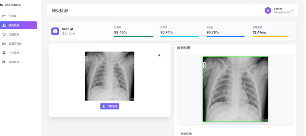【yolo 系列】基于yolov8的肺炎检测系统【python源码html前端数据集训练代码】 Csdn博客