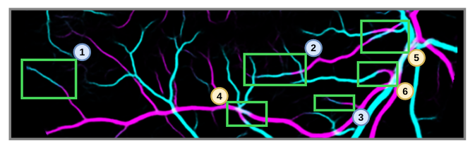 【分割】RRWNet: Recursive Refinement Network for effective retinal artery/vein segmentation-CSDN博客
