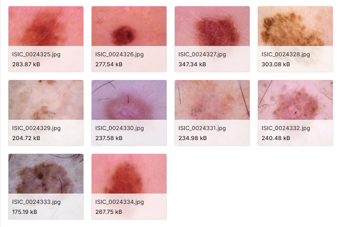 【CV数据集介绍-39】皮肤癌研究利器：HAM10000 数据集详解与应用-CSDN博客