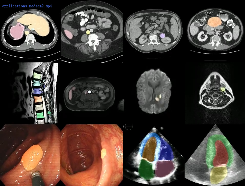 医疗影像AI大突破！MedSAM2 一键搞定动态视频分割，医生效率翻10倍！-CSDN博客