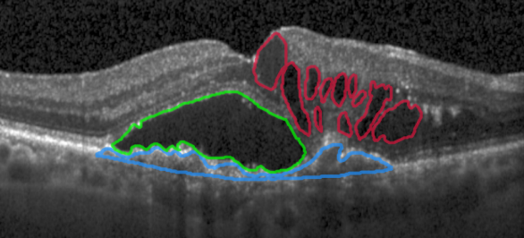 常见的 OCT 眼底疾病数据集(OCT2017、Eye OCT Datasets、OCTDL、RetinalOCT_Dataset-C8、RETOUCH和OCTA-500)_oct数据集-CSDN博客