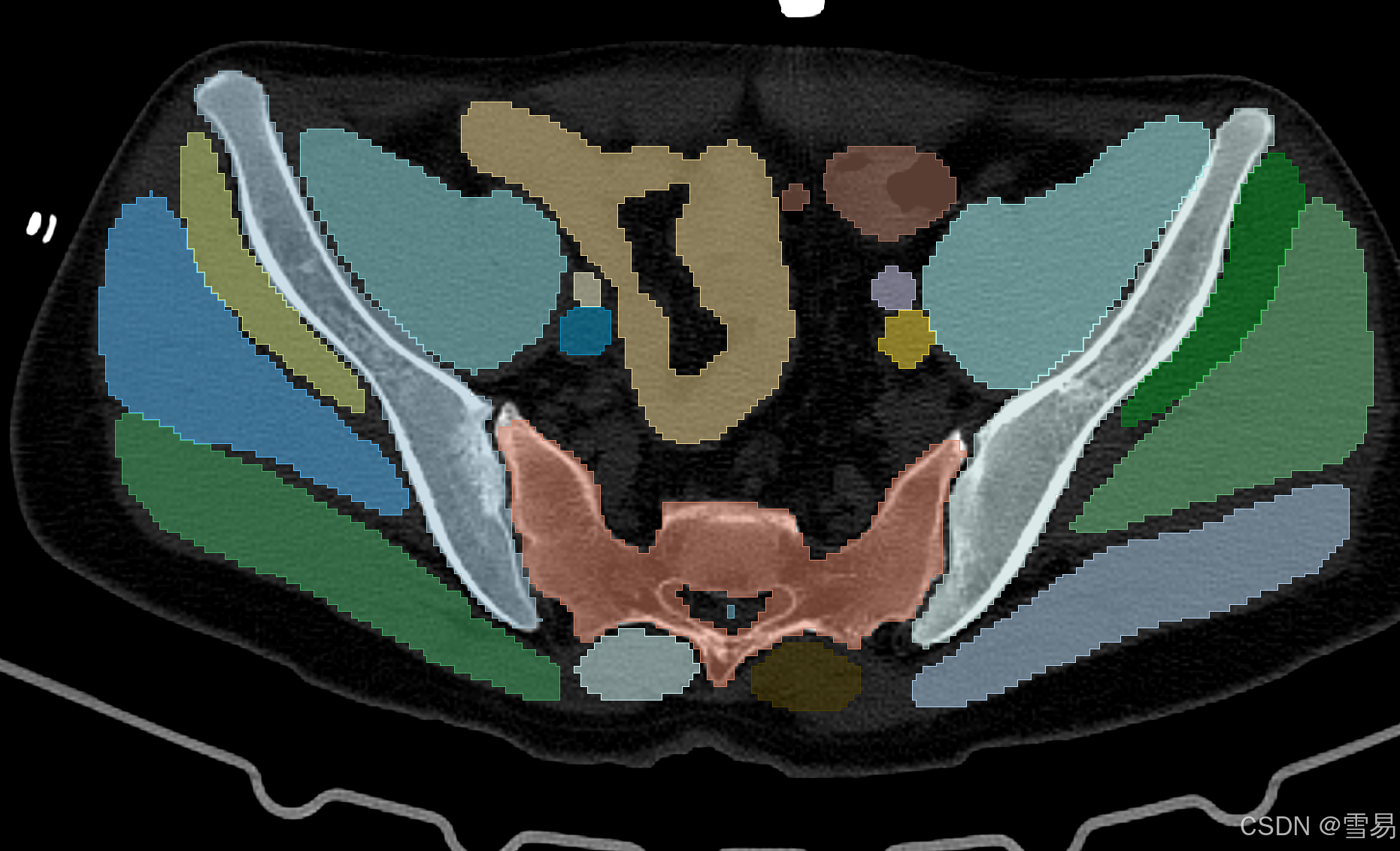 TotalSegmentator---针对CT/MRI数据的自动分割_totalsegmentator python版本-CSDN博客