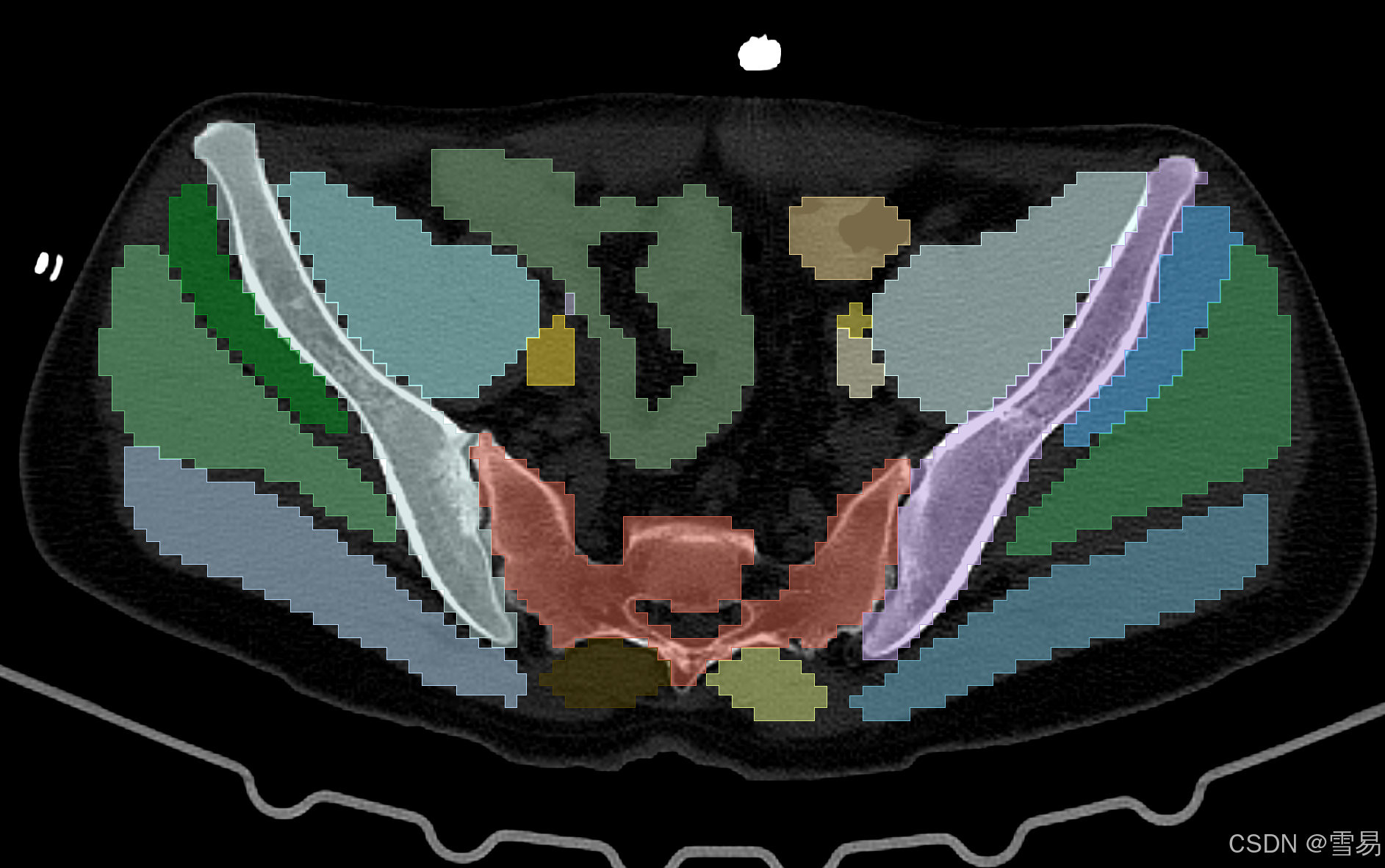 TotalSegmentator---针对CT/MRI数据的自动分割_totalsegmentator python版本-CSDN博客