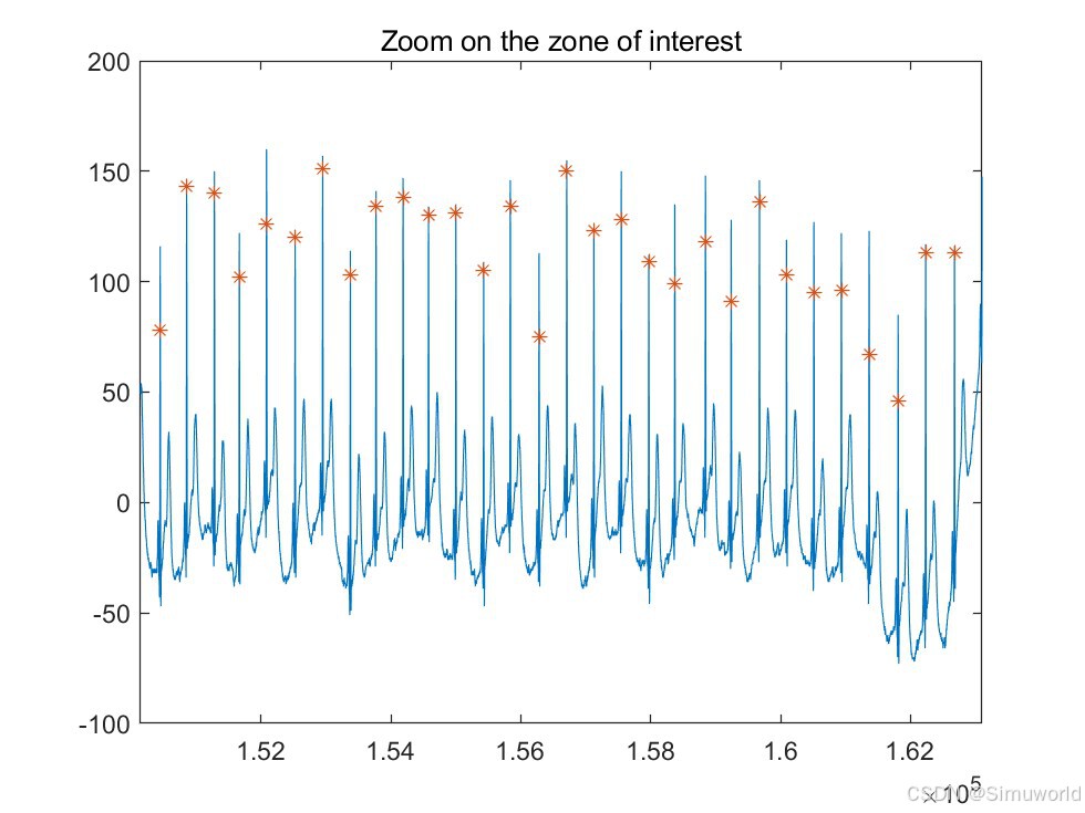 基于带通滤波的ECG信号P波检测matlab仿真-CSDN博客