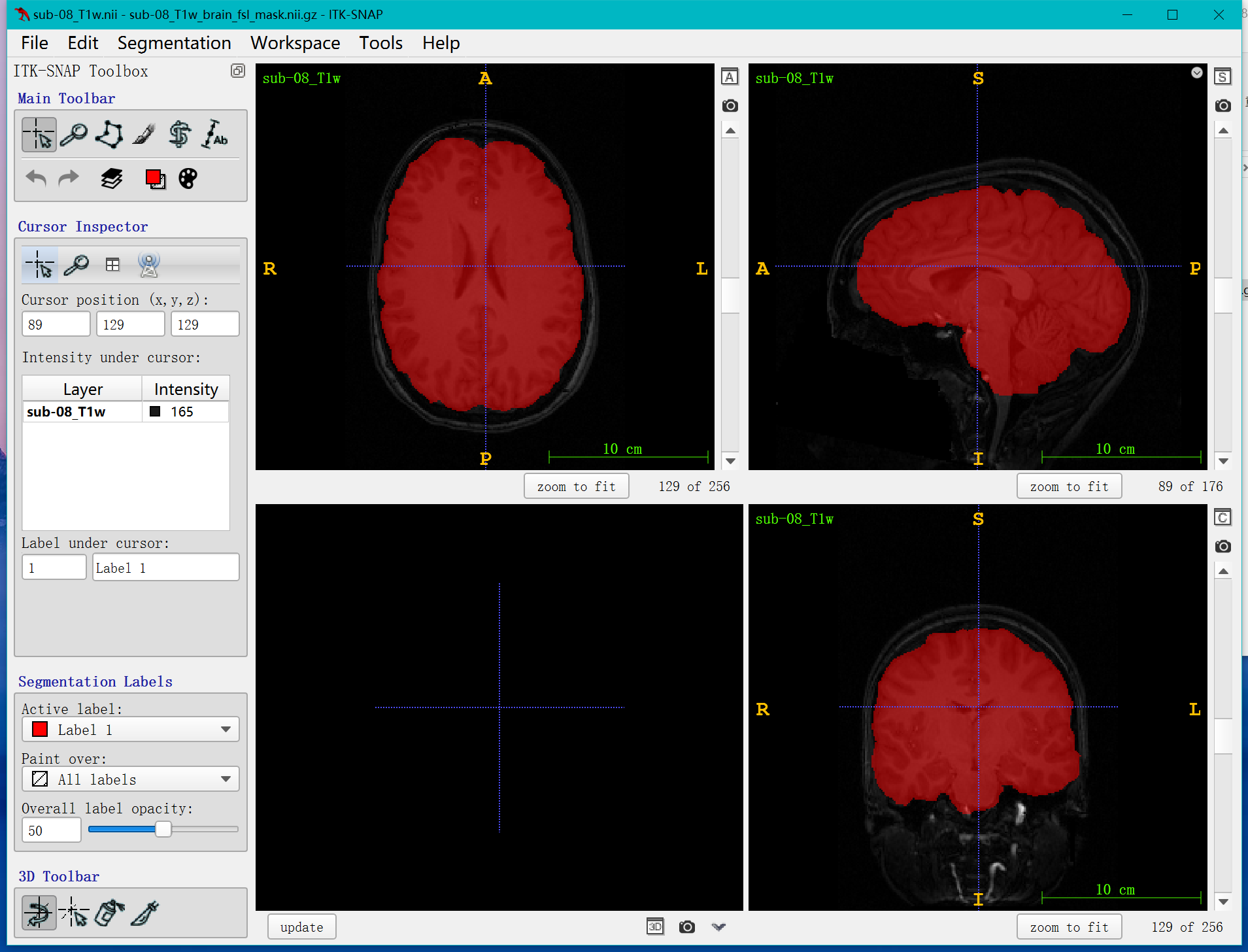 FSL-BET2、SPM-CAT12、Deepbet颅骨分离效果比较_cat12去除颅骨-CSDN博客