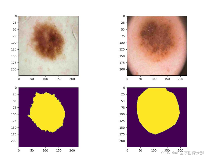 基于Unet3+实现的皮肤病ISIC医学图像语义分割项目_isic数据集分割-CSDN博客