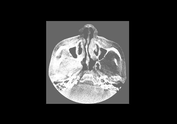 VTK API 详解（93）：vtkImageMapToWindowLevelColors - 基于窗宽窗位映射DICOM图像_VTK常用API教程字典-CSDN专栏