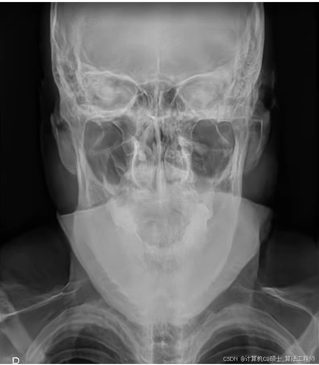 使用卷积神经网络（cnn）选择efficientnet预训练模型进行微调医疗图像数据集，处理训练应用ct，x光射线，核磁共振的主要疾病医疗图像数据集efficientnet微调 Csdn博客