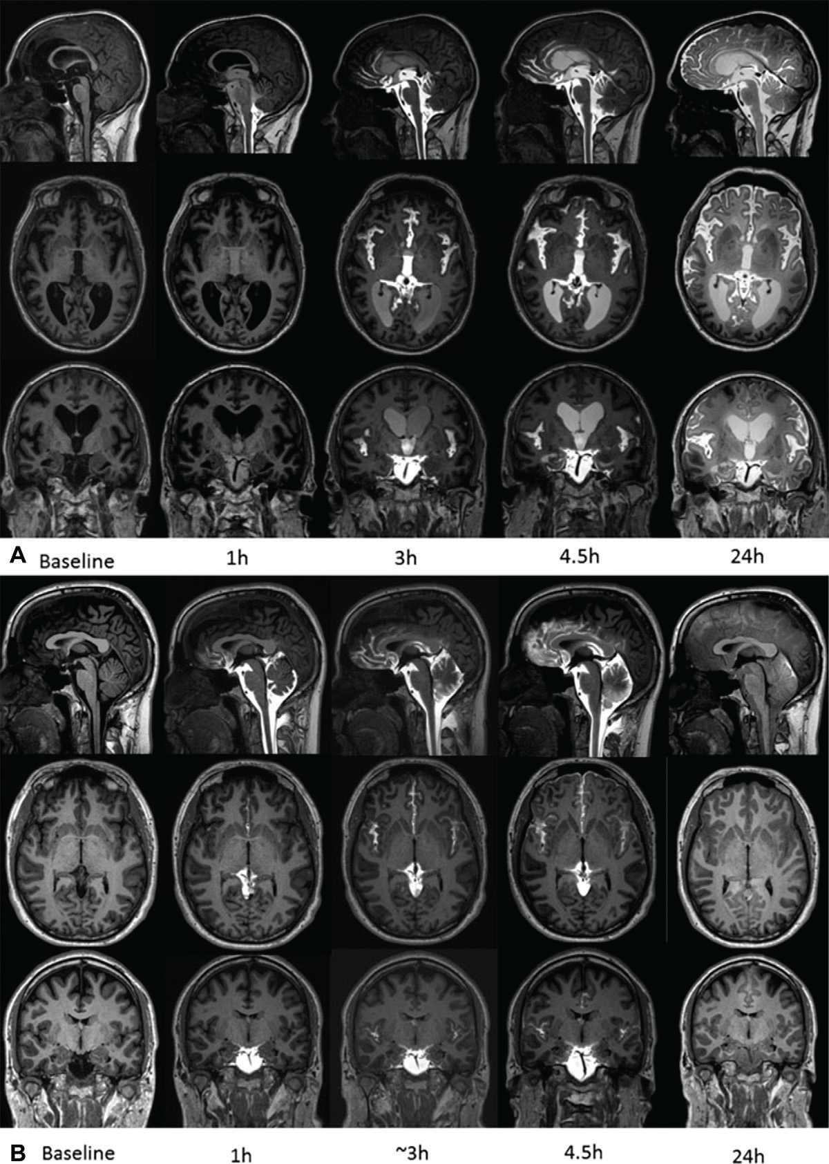 深度解读 | 颅内 Glymphatic 系统成像技术与临床应用全景_imaging the glymphatic system. radiology.-CSDN博客