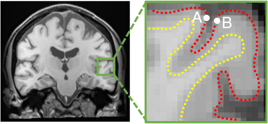 [TPAMI 2022]Learnable Pooling in Graph Convolutional Networks for Brain Surface Analysis-CSDN博客