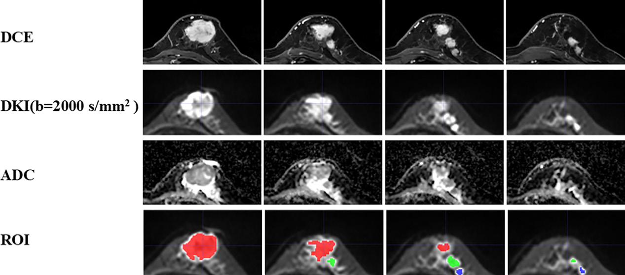多 b 值扩散 MRI 模型预测乳腺癌新辅助化疗病理完全缓解_dki b值取值-CSDN博客