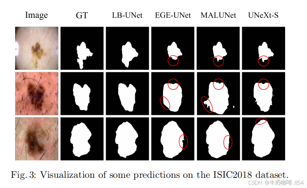 医图顶会 MICCAI‘24 | LB-UNet: A Lightweight Boundary-assisted UNet for Skin Lesion Segmentation-CSDN博客