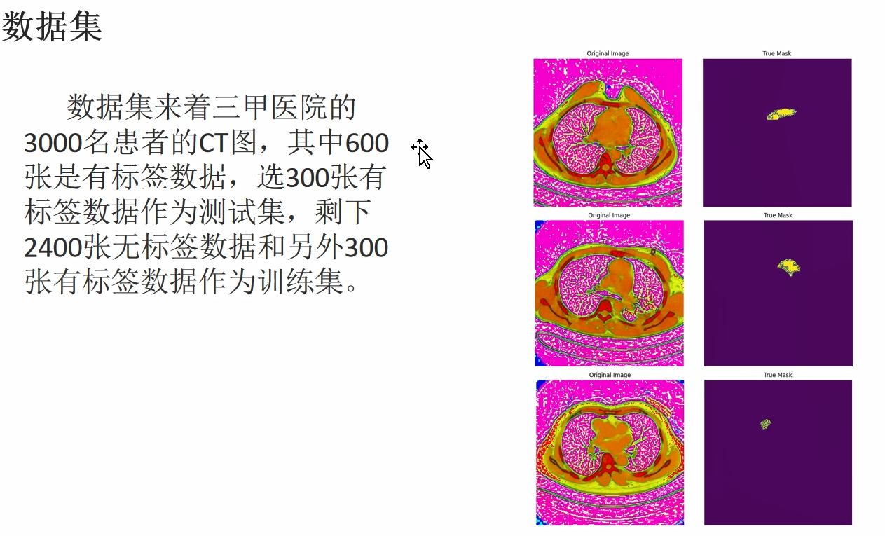视频讲解：BSNet模型（双边监督网络）结合医学CT影像与半监督学习SSL、卷积神经网络CNN的图像分割方案-CSDN博客