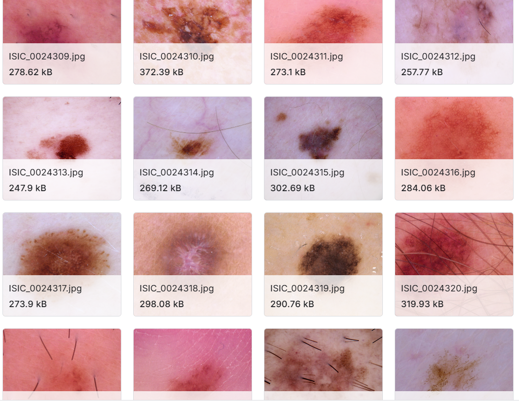 【CV数据集介绍-39】皮肤癌研究利器：HAM10000 数据集详解与应用-CSDN博客