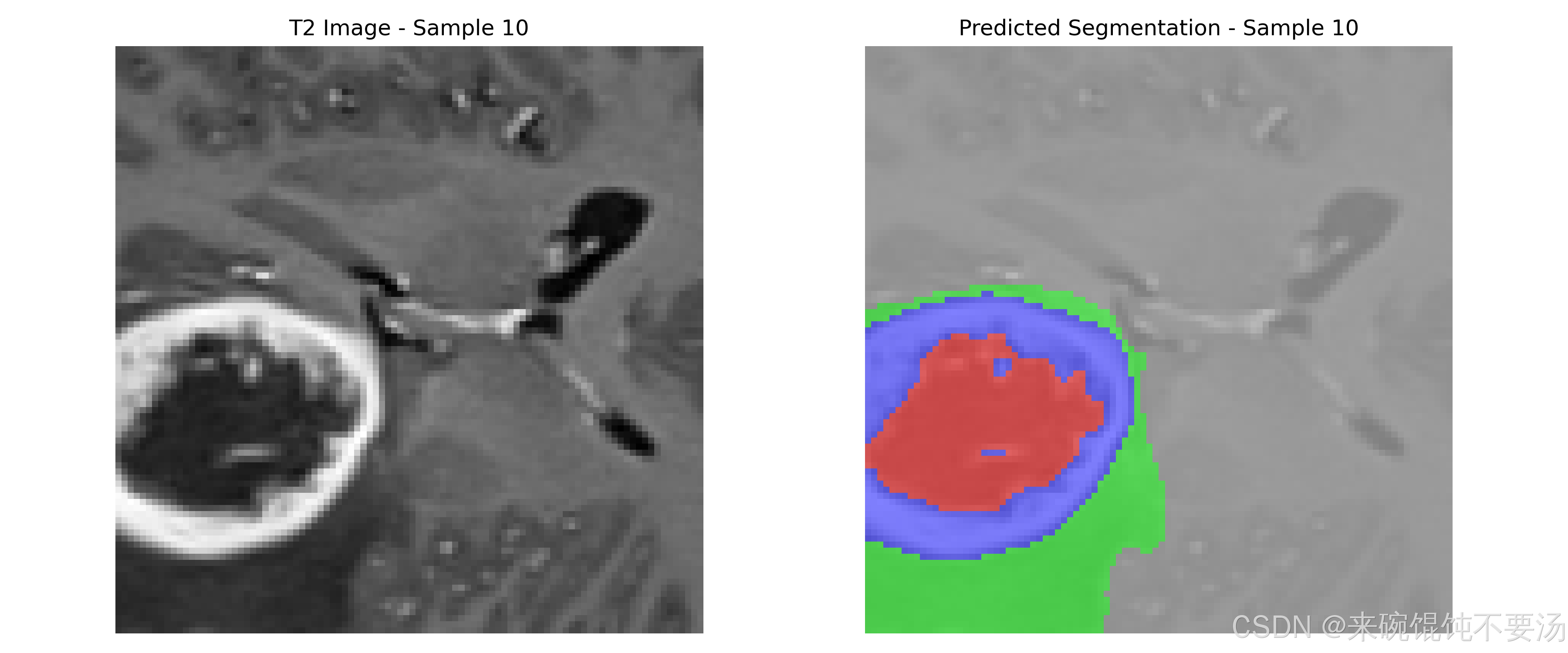 轻量级3D U-Net在4G显存下的极限挑战：脑肿瘤多模态MRI分割的技术实践-CSDN博客