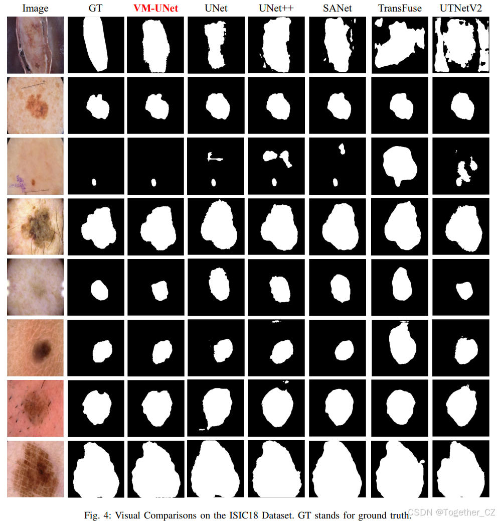 VM-UNet: Vision Mamba UNet for Medical Image Segmentation——用于医学图像分割的视觉Mamba UNet-CSDN博客