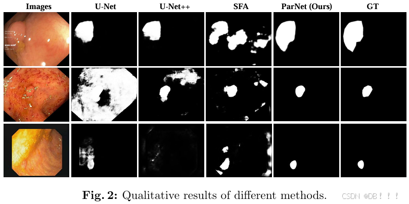 【结肠息肉AI论文集】PraNet: Parallel Reverse Attention Network for Polyp Segmentation-CSDN博客