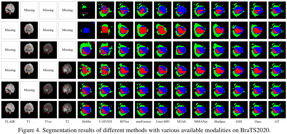 CVPR 2025 | Incomplete Multi-modal Brain Tumor Segmentation via Learnable Sorting State Space ...