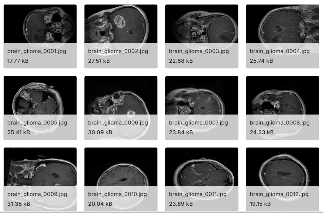 【CV数据集介绍-04】孟加拉国脑癌 MRI 数据集：助力脑肿瘤分类研究_ce-mri数据集-CSDN博客