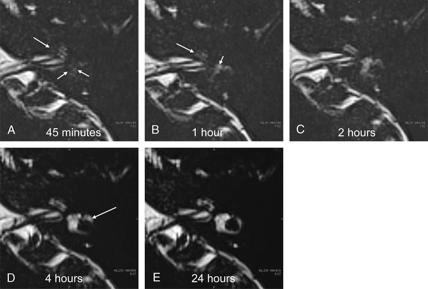 磁共振成像（MRI）：揭秘大脑“清洁系统”——类淋巴系统_alps指数-CSDN博客