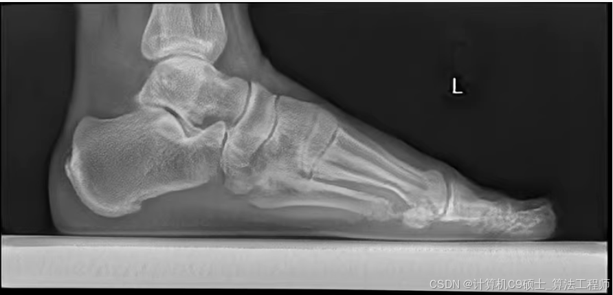 使用卷积神经网络（cnn）选择efficientnet预训练模型进行微调医疗图像数据集，处理训练应用ct，x光射线，核磁共振的主要疾病医疗图像数据集efficientnet微调 Csdn博客