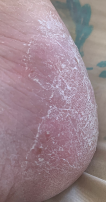 tinea manus et pedis -CSDN博客