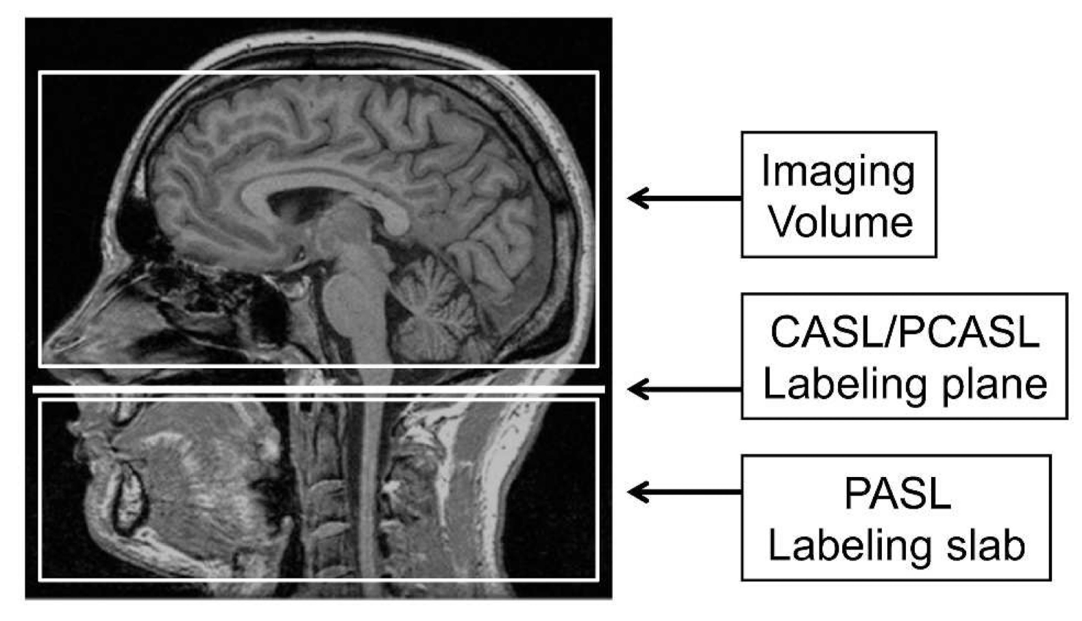 【深度解析】ASL 灌注 MRI 标准化进展：从临床实施到术语规范的双共识指南-CSDN博客