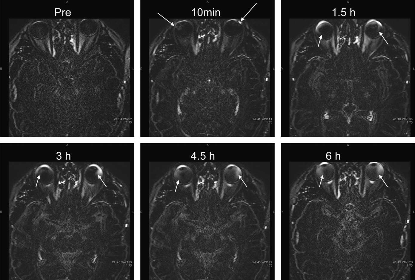 磁共振成像（MRI）：揭秘大脑“清洁系统”——类淋巴系统_glymphatic system-CSDN博客
