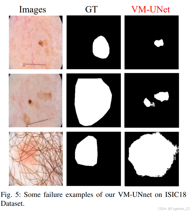 VM-UNet: Vision Mamba UNet for Medical Image Segmentation——用于医学图像分割的视觉Mamba UNet-CSDN博客