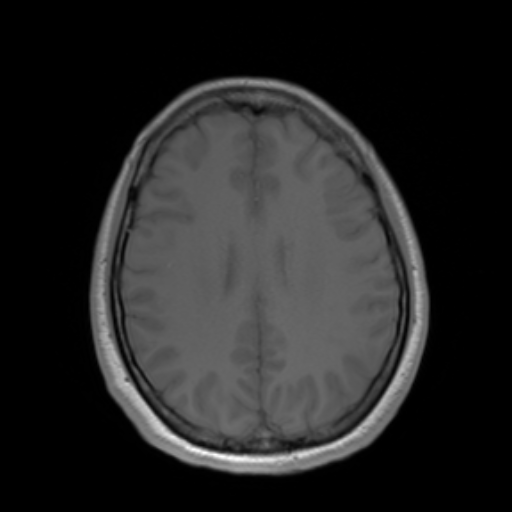 基于 Diffusion 模型的 MRI 图像模态转换：从理论到实战（附完整代码框架）_multishell diffusion mri-CSDN博客