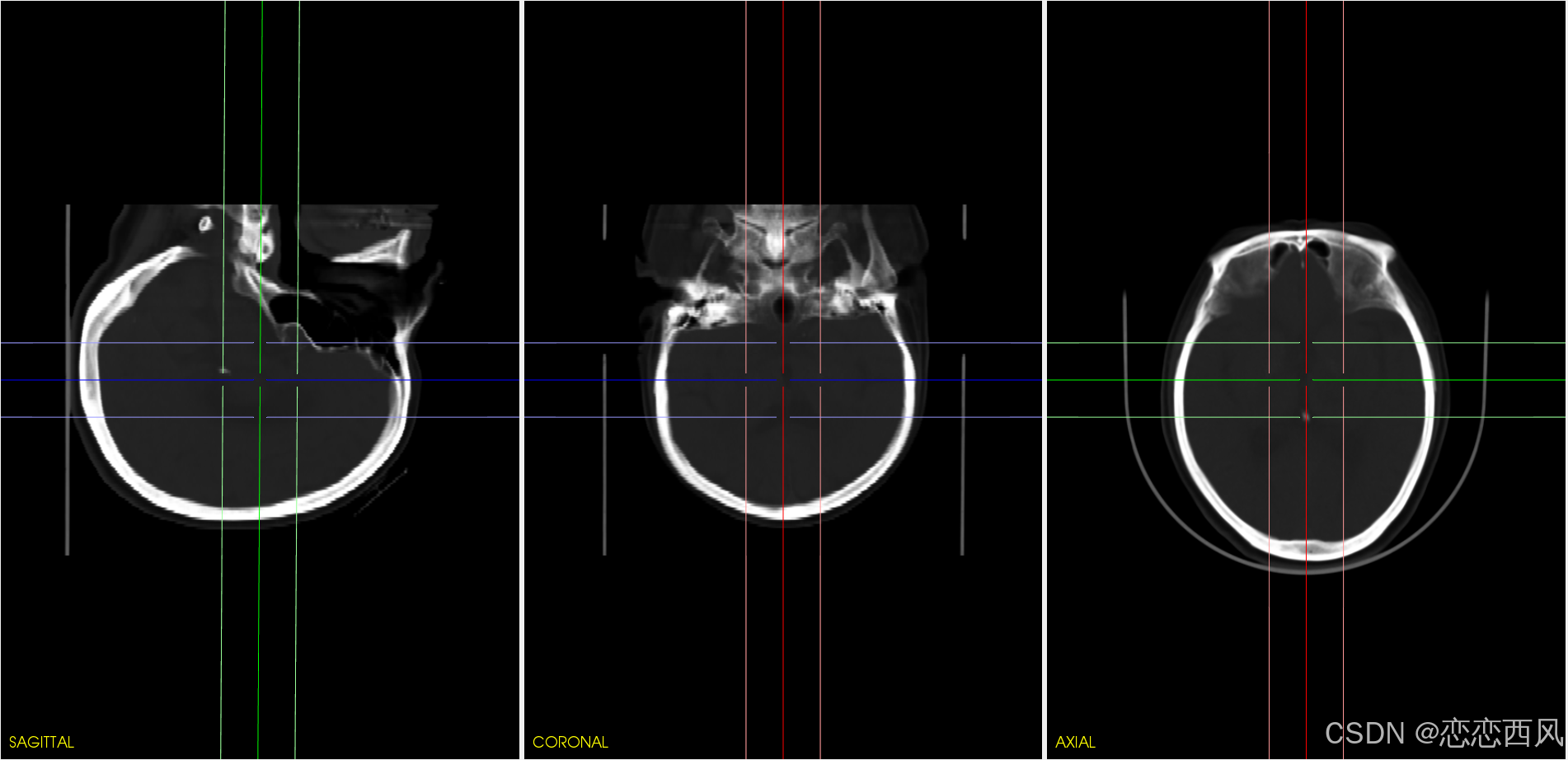 CT 平均投影(Composite) , 最大密度投影(MIP),最小密度投影(MinMIP) 三种投影方式，使用场景-CSDN博客