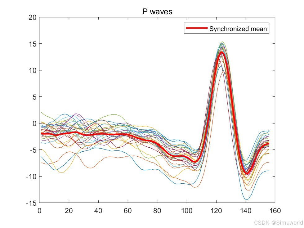 基于带通滤波的ECG信号P波检测matlab仿真-CSDN博客