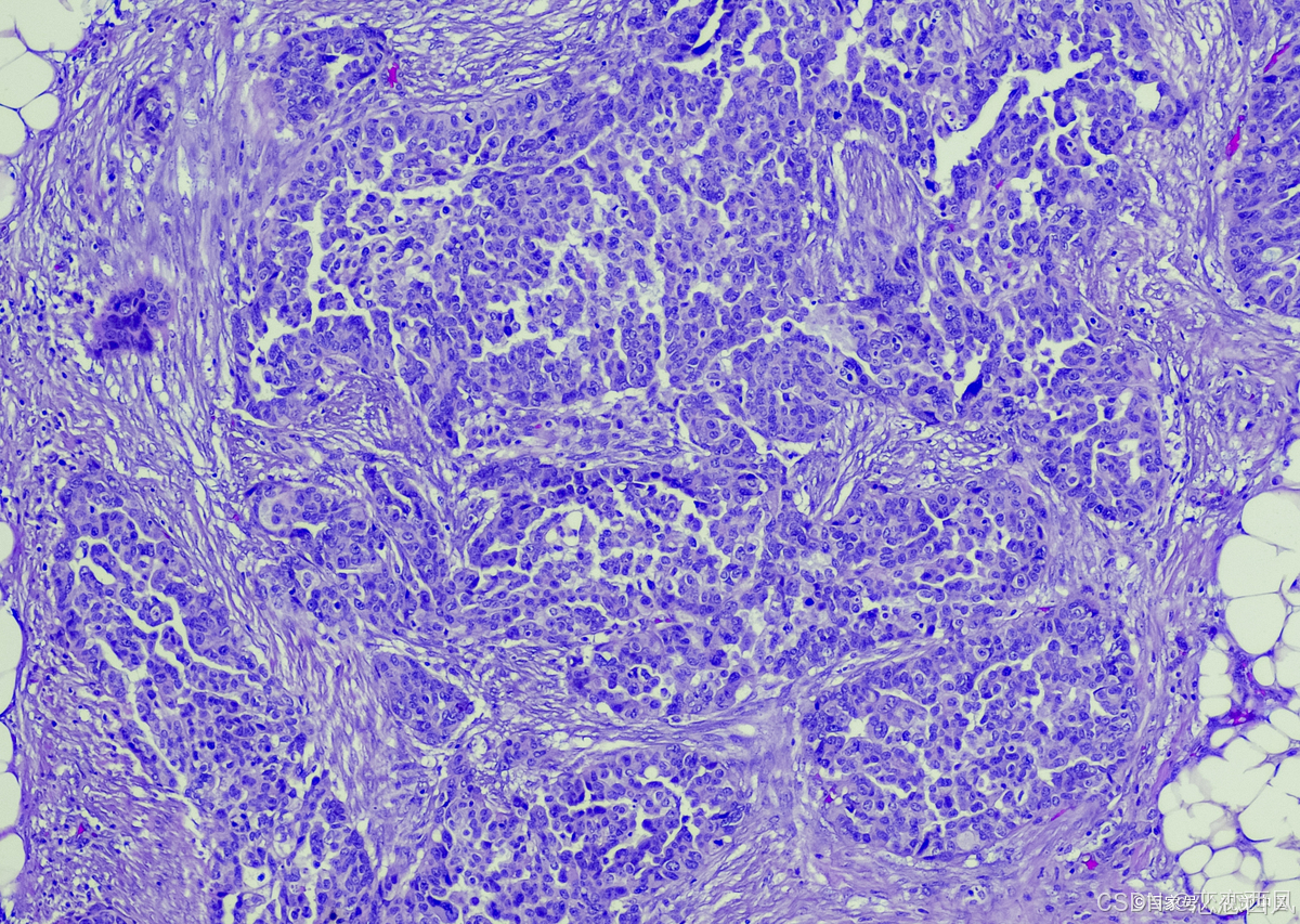 普通CT、增强 CT、PET-CT 区别-CSDN博客