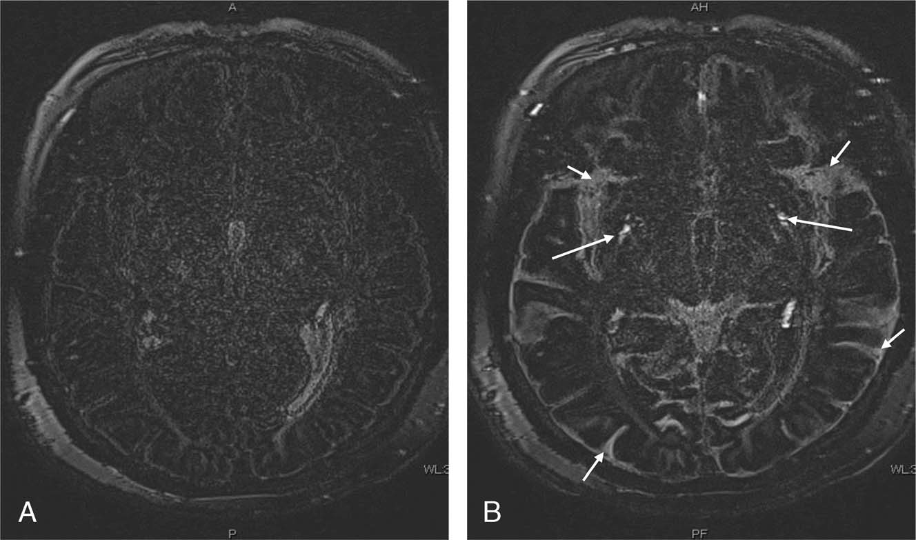 磁共振成像（MRI）：揭秘大脑“清洁系统”——类淋巴系统_alps指数-CSDN博客