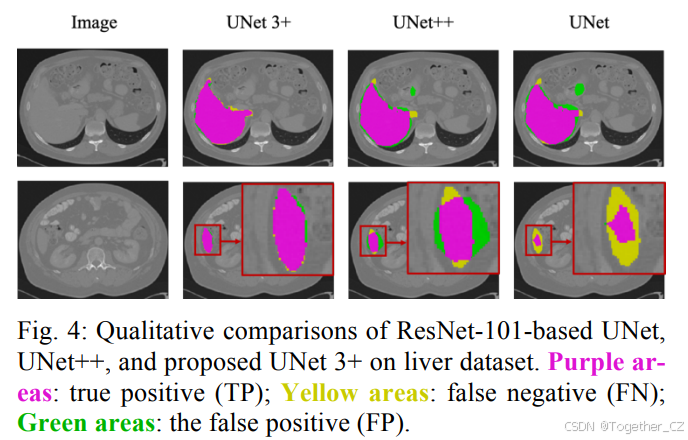 UNET 3+: A FULL-SCALE CONNECTED UNETFOR MEDICAL IMAGE SEGMENTATION——一种全尺度连接的UNet用于医学图像分割_unet 3 ...