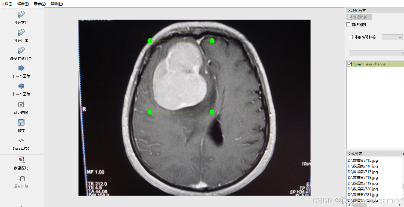 【人工智能】基于深度学习的脑肿瘤CT图像检测_深度学习ct-CSDN博客