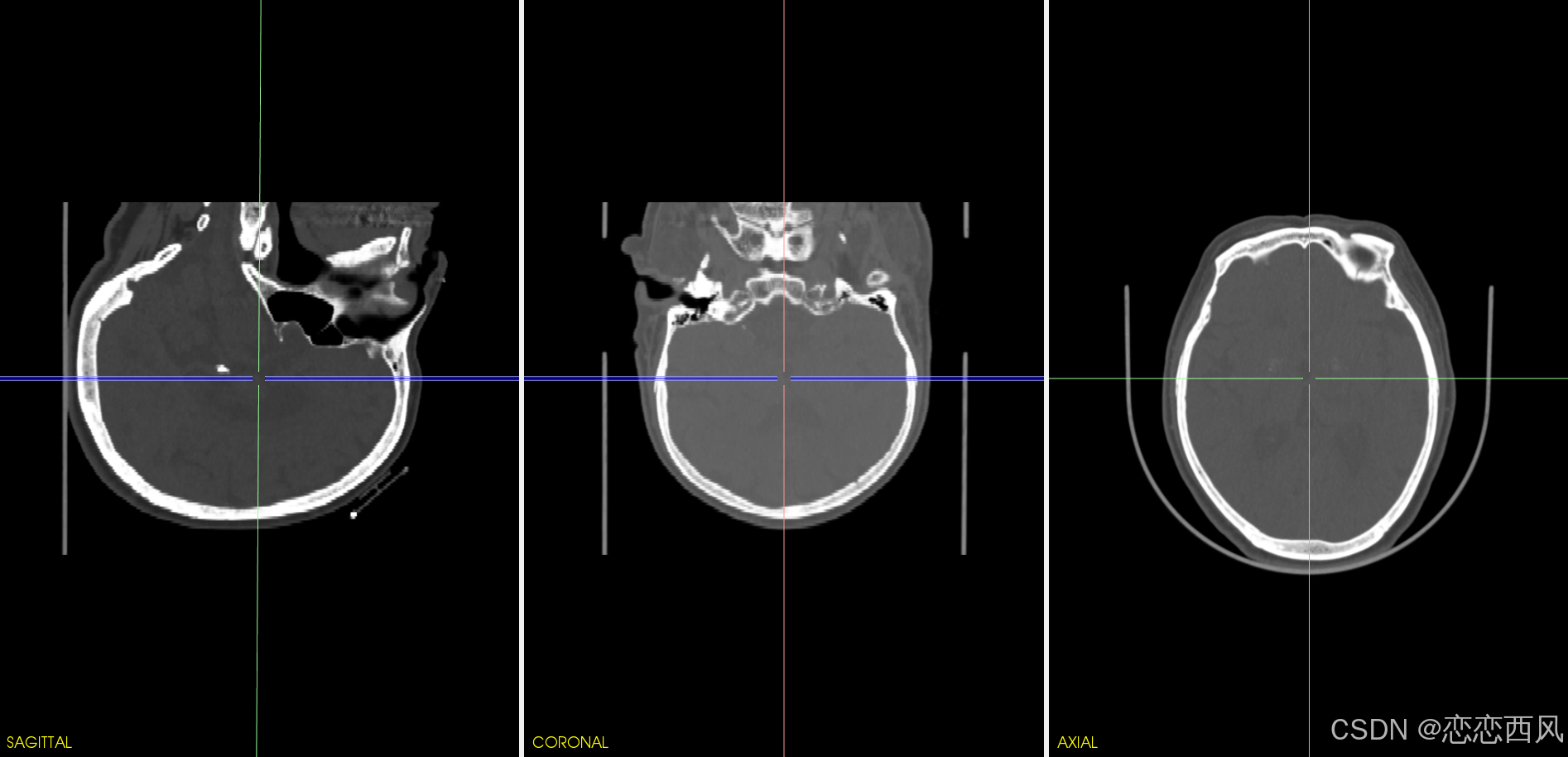 CT 平均投影(Composite) , 最大密度投影(MIP),最小密度投影(MinMIP) 三种投影方式，使用场景_ct最大密度投影和最小密度-CSDN博客