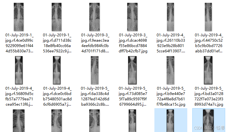 基于YOLO11的脊柱侧弯X射线检测系统（Python源码+数据集+Pyside6界面）_yolov11-pose 判断脊柱侧弯-CSDN博客