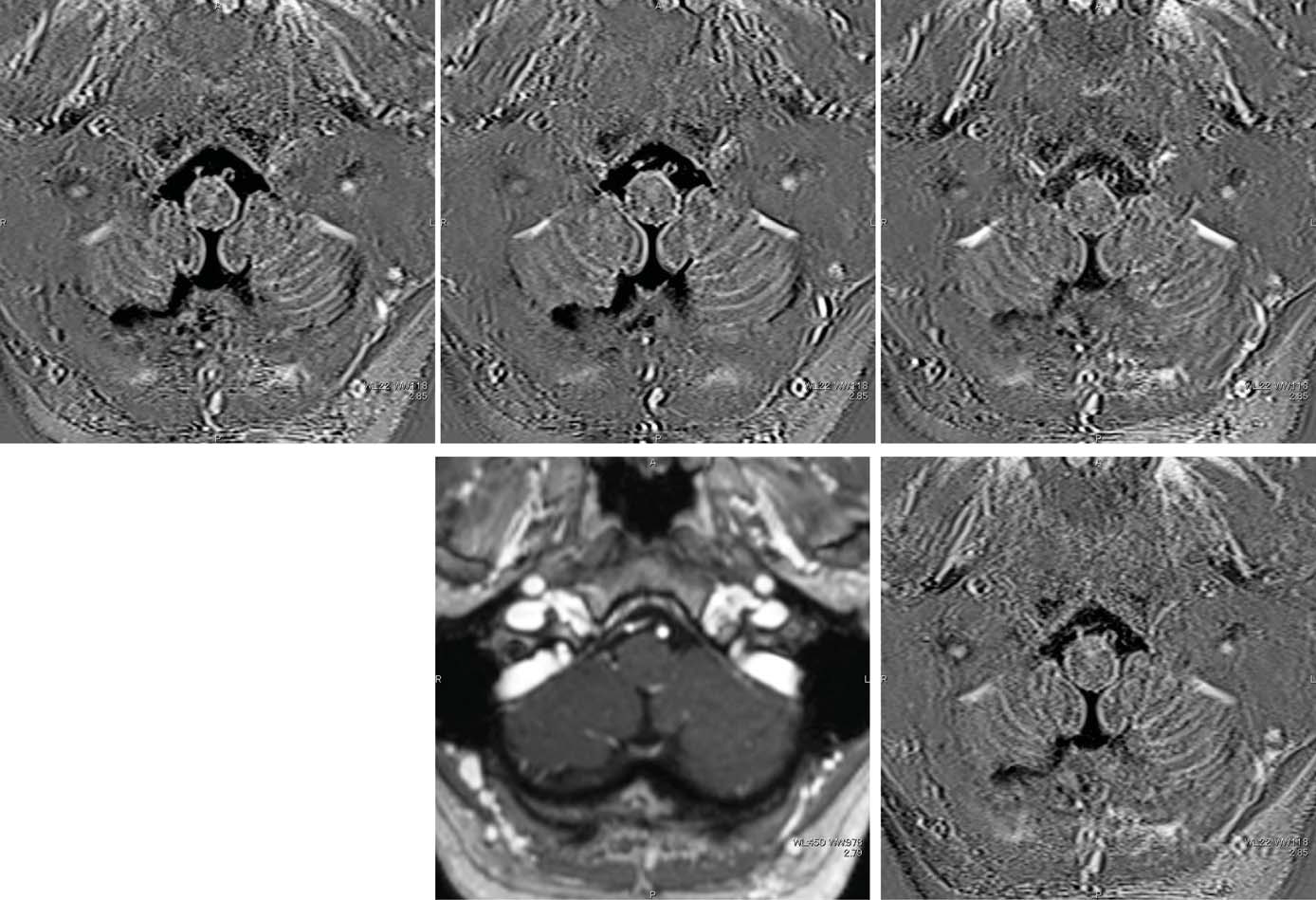 磁共振成像（MRI）：揭秘大脑“清洁系统”——类淋巴系统_alps指数-CSDN博客