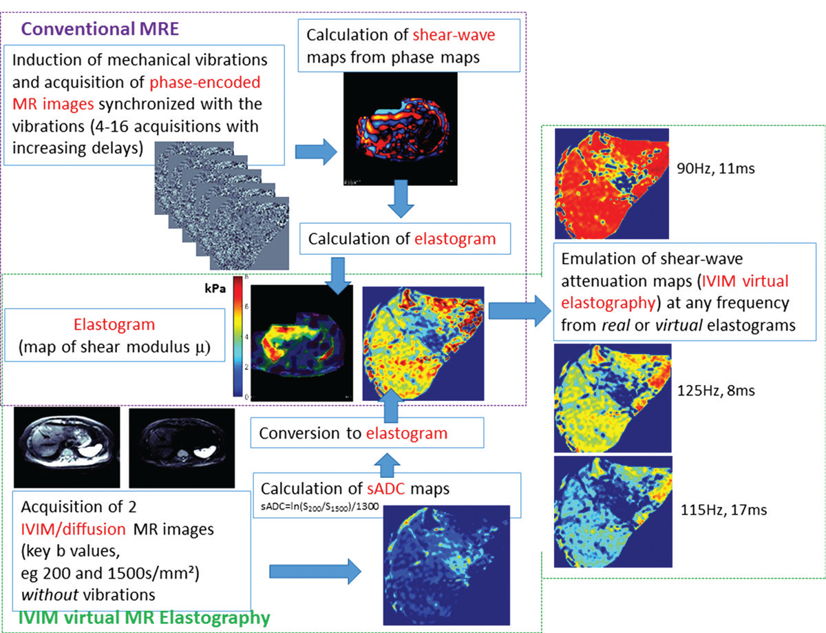 扩散与体素内不相干运动 MR 成像驱动的虚拟弹性成像在肝脏研究中的新突破_西门子mre指纹弹性成像-CSDN博客