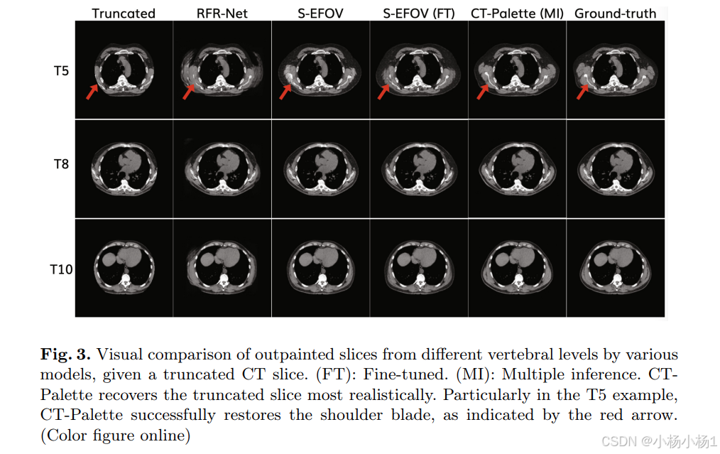 基于扩散模型的生成图像用于恢复 FOV 截断 CT 图像_扩散模型ct重建-CSDN博客