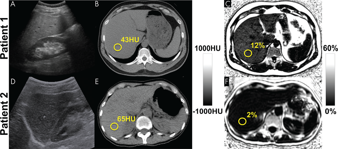 CT 和 MRI 在肝脏脂肪量化中的最新进展及临床应用_quantification of liver fat content with ct and mr-CSDN博客