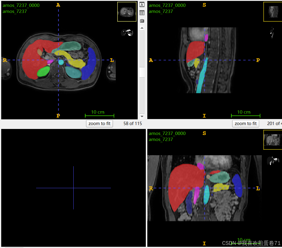 U-Mamba复现_umamba复现-CSDN博客