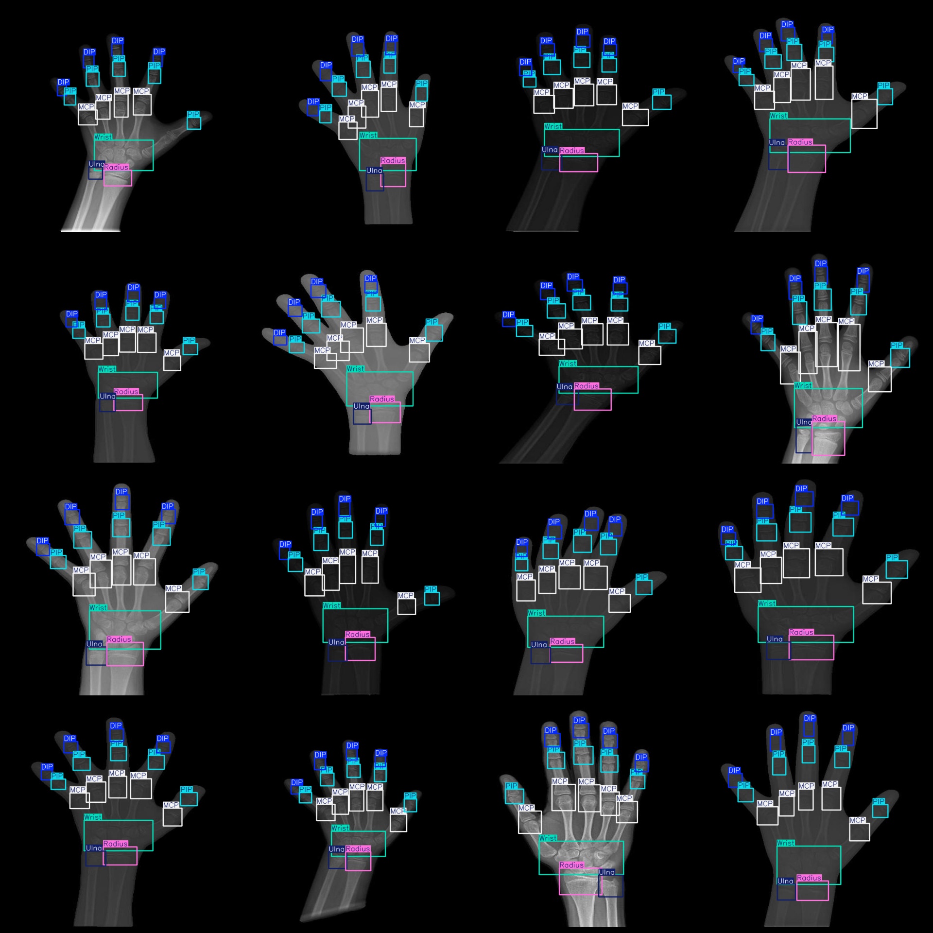 基于yolov8的X光图像手骨检测系统python源码+onnx模型+评估指标曲线+精美GUI界面_基于yolov8的x光骨骼医疗场景下人体手 ...